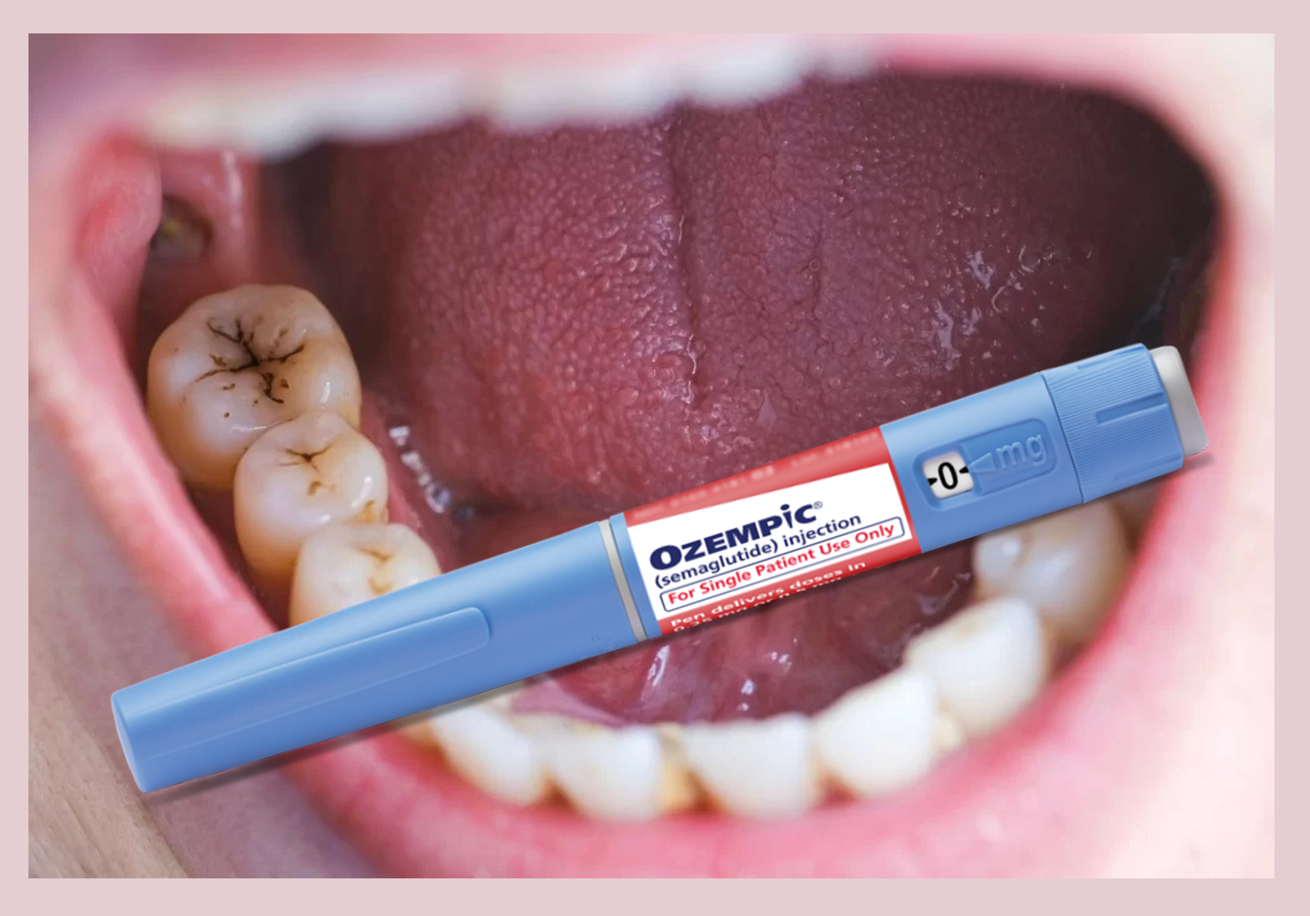 Ozempic Teeth: What Dentists Are Seeing and How to Protect Your Smile